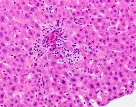 Primary Sclerosing Cholangitis Histology