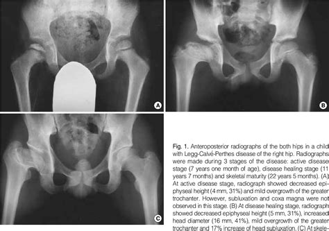 Figure 1 From Femoral Head Deformity In Legg Calve Perthes Disease Semantic Scholar