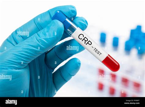Crp Test Tube Labcorp At Marvin Goff Blog
