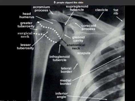 Shoulder Disloction For Homoeopathic Surgery Pptx