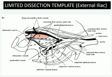 Eau 2024 Pelvic Lymph Node Dissection In Prostate Cancer Update Of The Limited Vs Extended