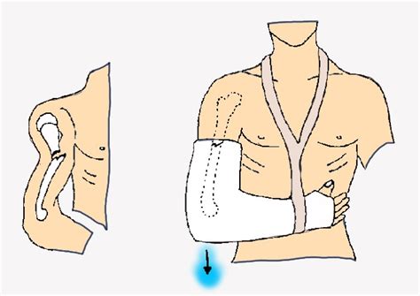 Hanging Arm Cast Humerus Question From Doctora Lo Humerusfracture