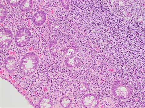 High Power Micrograph Of Colonic Mucosa Which Exhibits Moderate Active Download Scientific