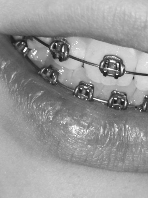 Виктория Боряк On Instagram Редкое фото улыбки с 😁 Braces