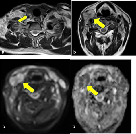 A 57 Year Old Man With Papillary Thyroid Nodule And Nodal Metastasis A Download Scientific