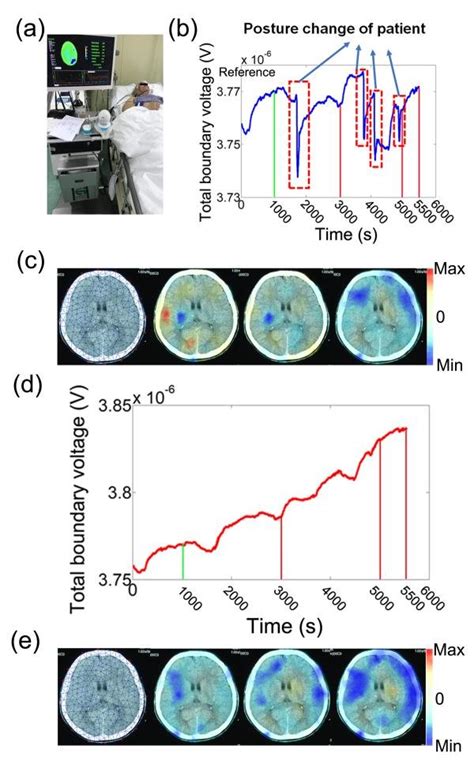 Management Of Erroneous Eit Data In Human Experiments With Ppm A