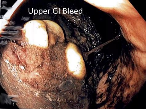 Endoscopic Hemostasis For Endoscopy Nurses Pdf