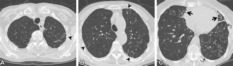 Interstitial Lung Abnormalities At Ct Subtypes Clinical Significance