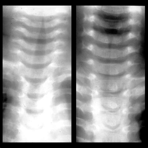 Radiografia Del Croup