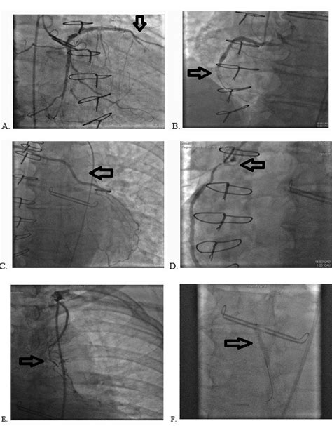 Closure Of Lima And A Saphenous Vein Graft Within A Short Period Of Six Months Post Cabg In