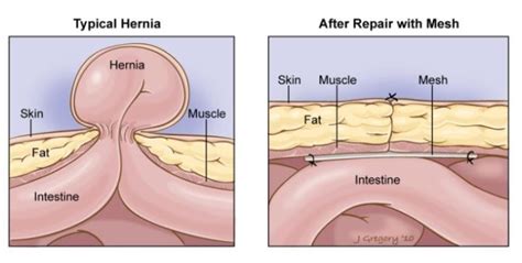 View Of The Body Structures Before And After Surgery Using Hernia Mesh
