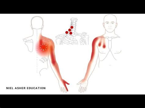 Scalenes Trigger Points