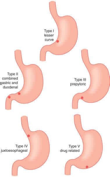 Peptic Ulcer Johnson Classification Epomedicine