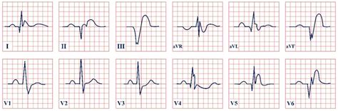 Electrocardiogram Aspect In Haïssaguerre Syndrome Diagnostic Criteria Download Scientific