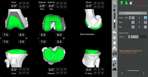 Robotic Knee Replacement Surgery Enhances Precision Personalization