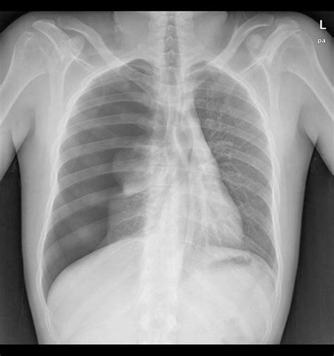 Mild Pneumothorax X Ray