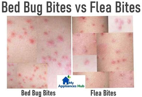 Bed Bug Bites Vs Flea Bites How To Tell The Differenc