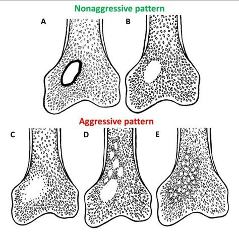 Diagram Illustrates Nonaggressive Radiograph Appearance A Well Defined Lytic Lesion With