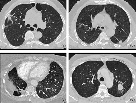 Lungx Challenge For Computerized Lung Nodule Classification