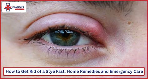 How To Get Rid Of A Stye Fast Home Remedies And Emergency Care