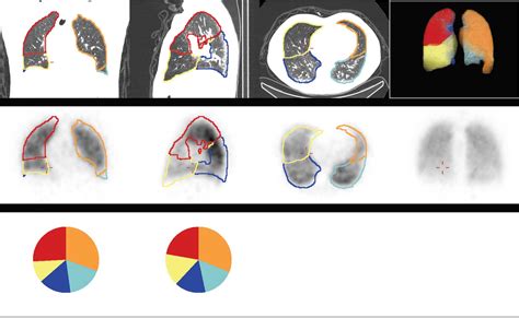 Lung Segments Vq