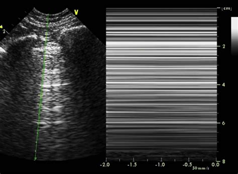 Pneumothorax Can Pocus Lung Help Point Of Care Ultrasound Certification Academy