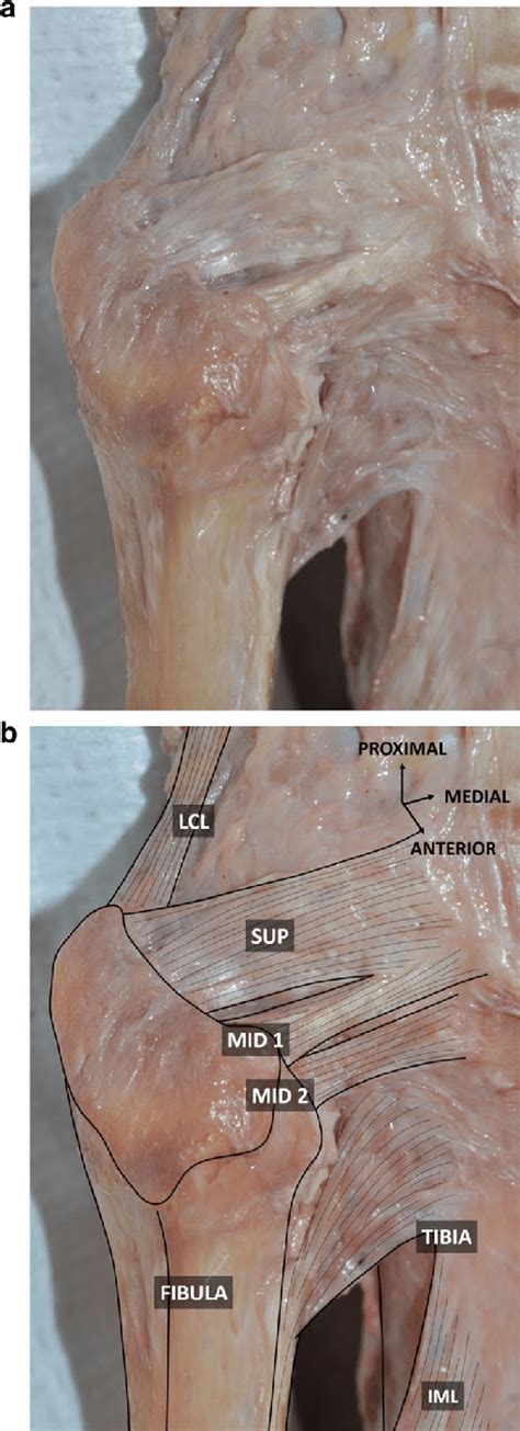 Anterolateral View Of The Proximal Tibiofibular Joint Without A And