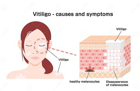 Causas Y Síntomas De La Ilustración Vectorial De Vitiligo Ilustración