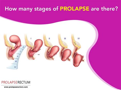 Rectal Prolapse Treatment By Herbal Ayurvedic Medicines