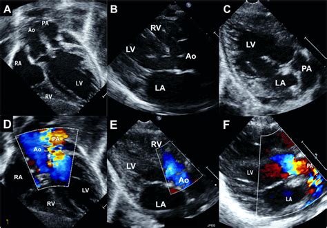 Echocardiogram Of First Patient Movie 1 Subxiphoid Coronal View A