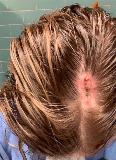 Moles On Scalp