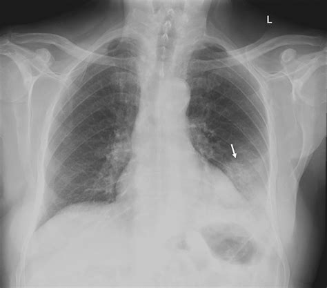 Can Pneumonia Be Lung Cancer