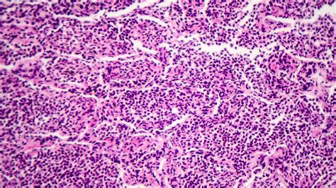 Cryobiopsy Versus Genomic Classifier A Hot Topic In Ilds Ers