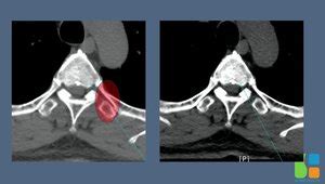 Trans SAP Approach For Thoracic Discectomy With Foraminoplasty