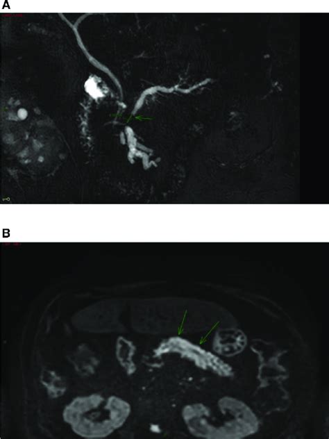 Magnetic Resonance Cholangiopancreatography Findings A Dilatation Of Download Scientific