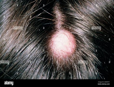Sebaceous Cyst On The Scalp Also Called A Steatoma Or Wen This Is A