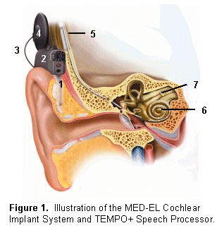 Fitting Techniques For The Pediatric Cochlear Implant Patient Article