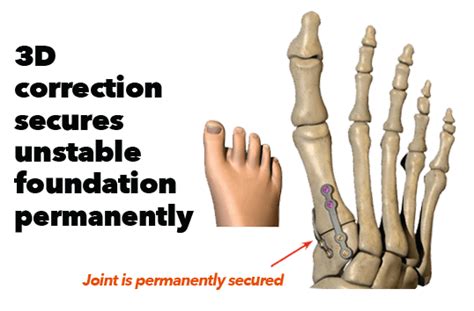 Lapiplasty Treatment Podiatrist Foot Doctor Festus And St Louis Mo