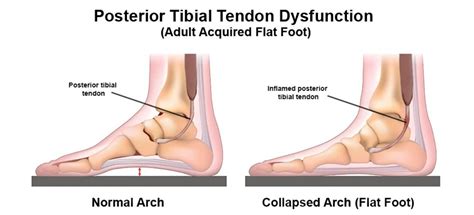 Posterior Tibial Tendon Dysfunction Pttd Pinnacle Vitality Rehab
