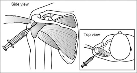 Ortho Shoulder Procedures Flashcards Quizlet