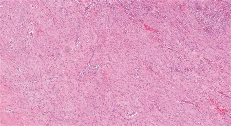 Nodular Fasciitis Archives Ottawa Atlas Of Pathology