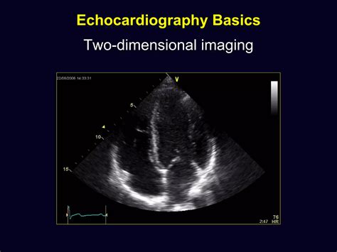 Basic Ecocardiography Ppt