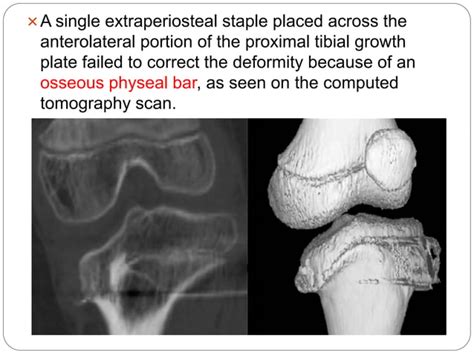 Physiological And Pathological Tibia Vara Ppt Death Injury Or