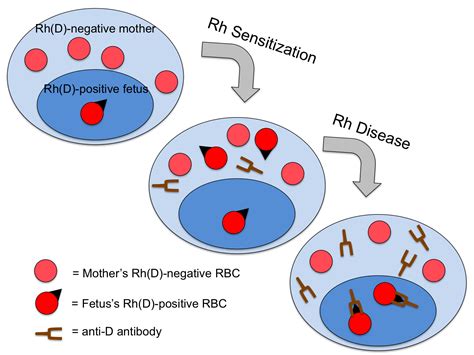 Using Rh Immune Globulin In Pregnancy To Prevent Rh Disease Atlas Of