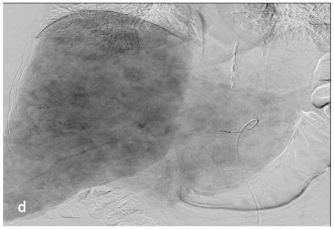 Cancers Free Full Text Conventional Transarterial Chemo Embolization Using Streptozocin In