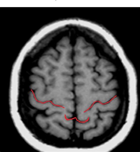 Axial Head Mri Scan