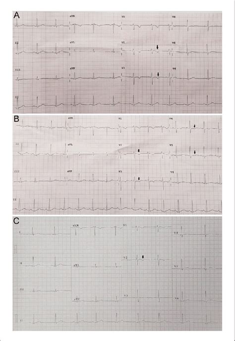 The Patients Serial Electrocardiograms Ecgs A The Patients