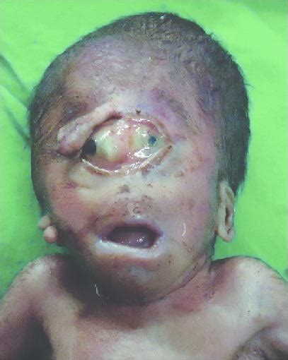 Cyclopia Usually Characterized By A Victim Having One Eye No Nose And