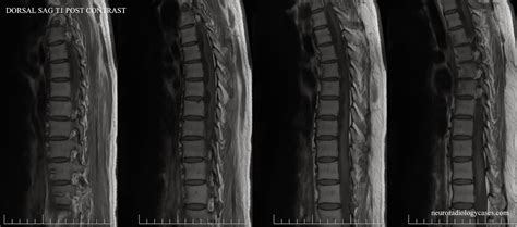 Dr Balaji Anvekar Frcr Focal Adhesive Arachnoiditis Of Spinal Cord