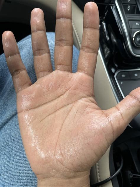 Humid Days Hit Different R Hyperhidrosis